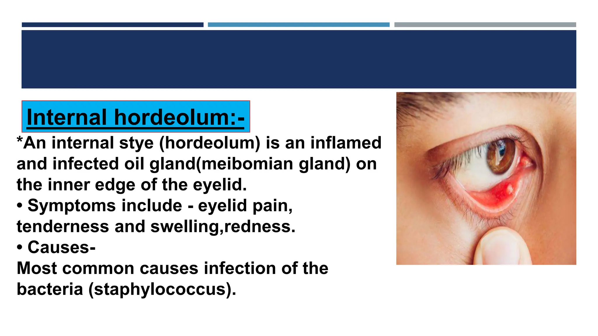 Diseases of eyelids like Epicanthus, entropian, ectropian, Telecanthus ...