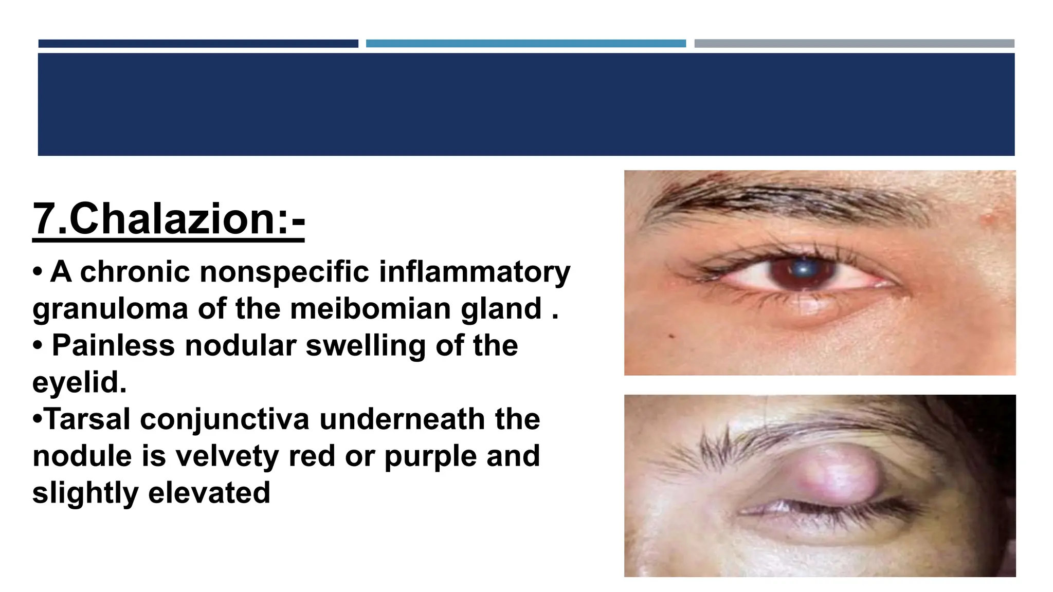 Diseases of eyelids like Epicanthus, entropian, ectropian, Telecanthus ...