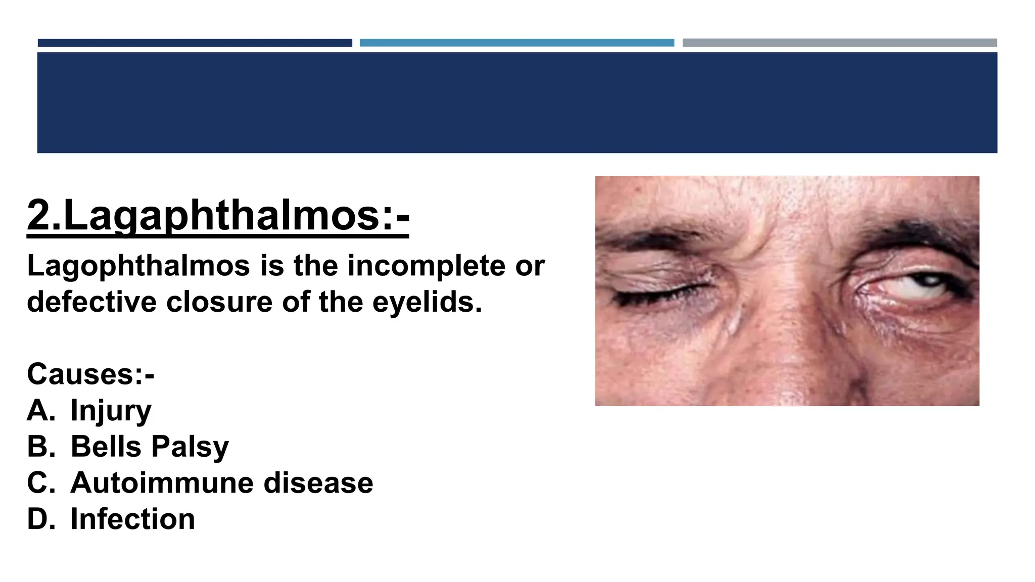 Diseases of eyelids like Epicanthus, entropian, ectropian, Telecanthus ...