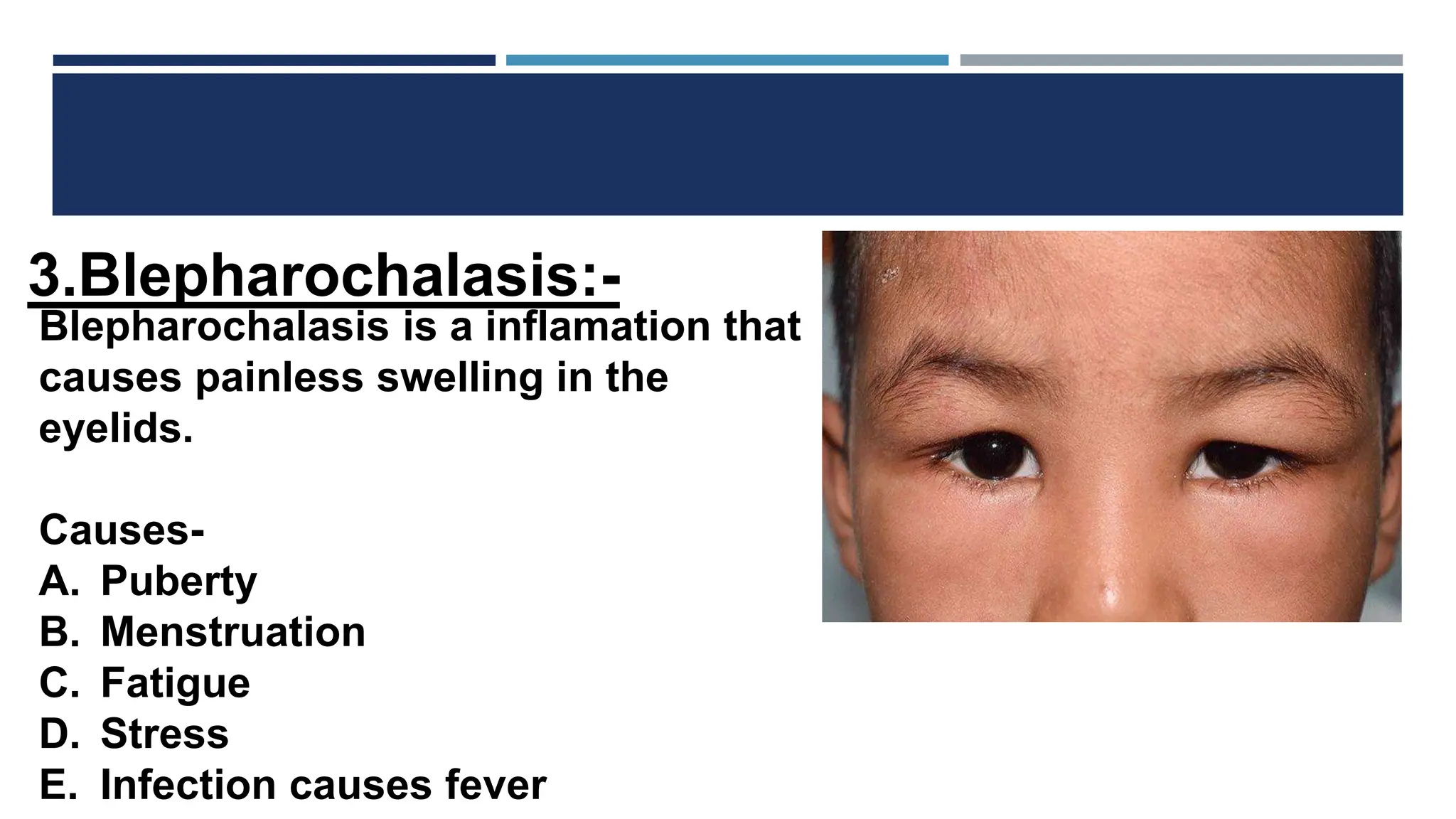 Diseases of eyelids like Epicanthus, entropian, ectropian, Telecanthus ...