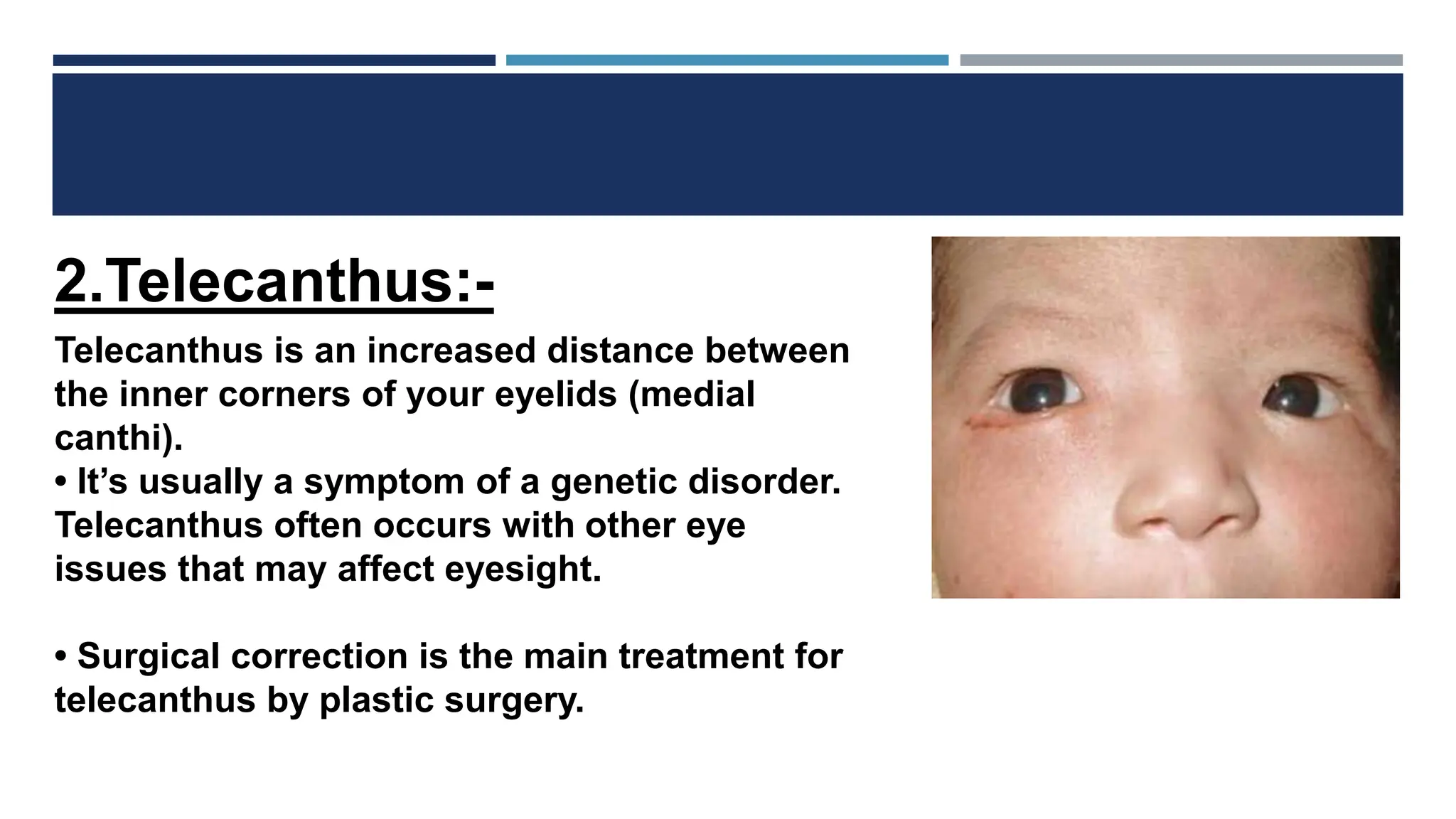 Diseases of eyelids like Epicanthus, entropian, ectropian, Telecanthus ...