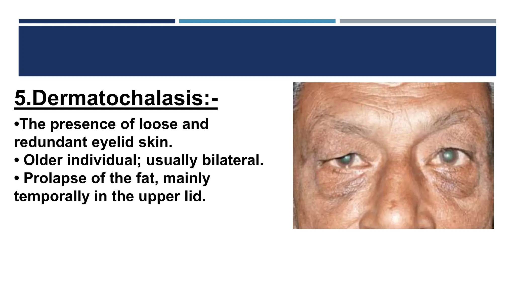Diseases of eyelids like Epicanthus, entropian, ectropian, Telecanthus ...