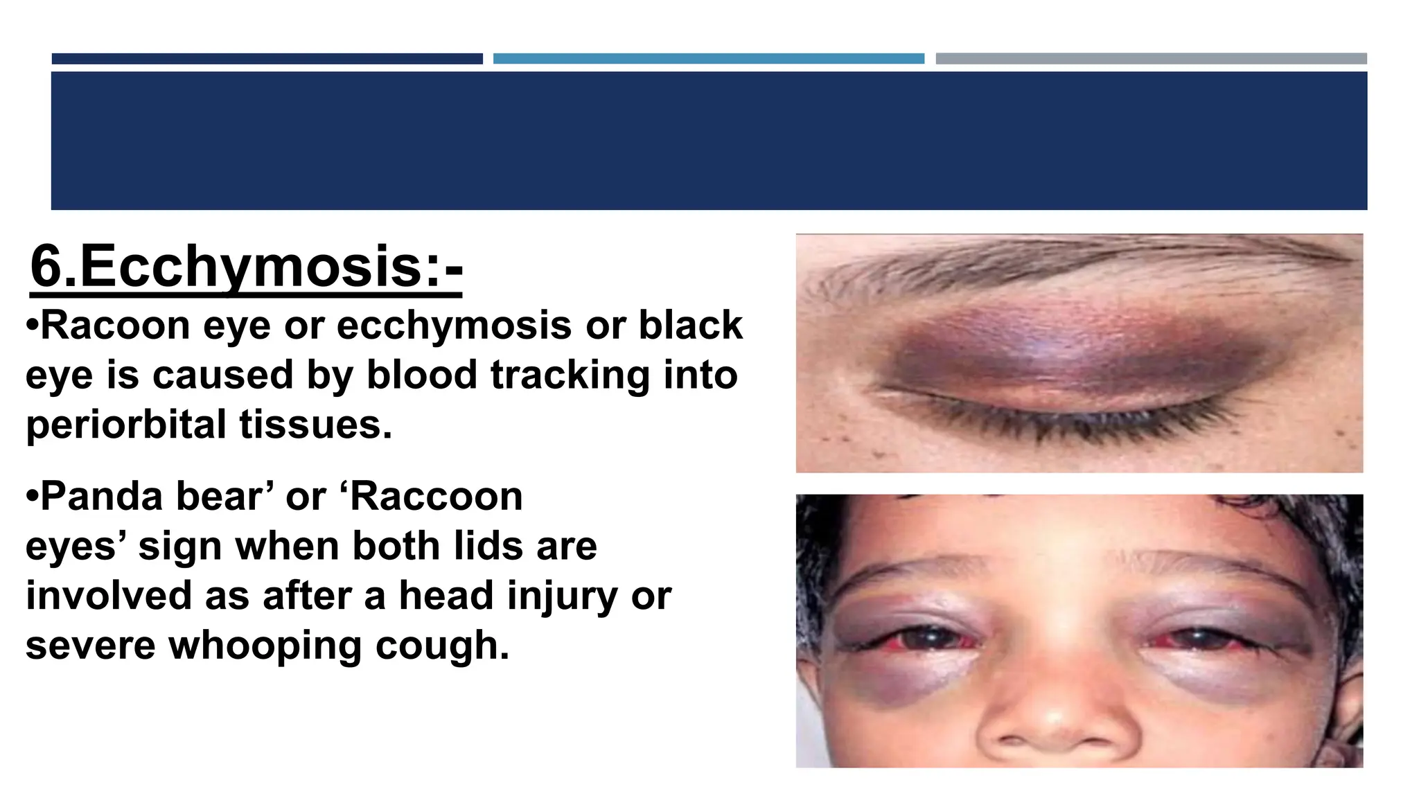 Diseases of eyelids like Epicanthus, entropian, ectropian, Telecanthus ...