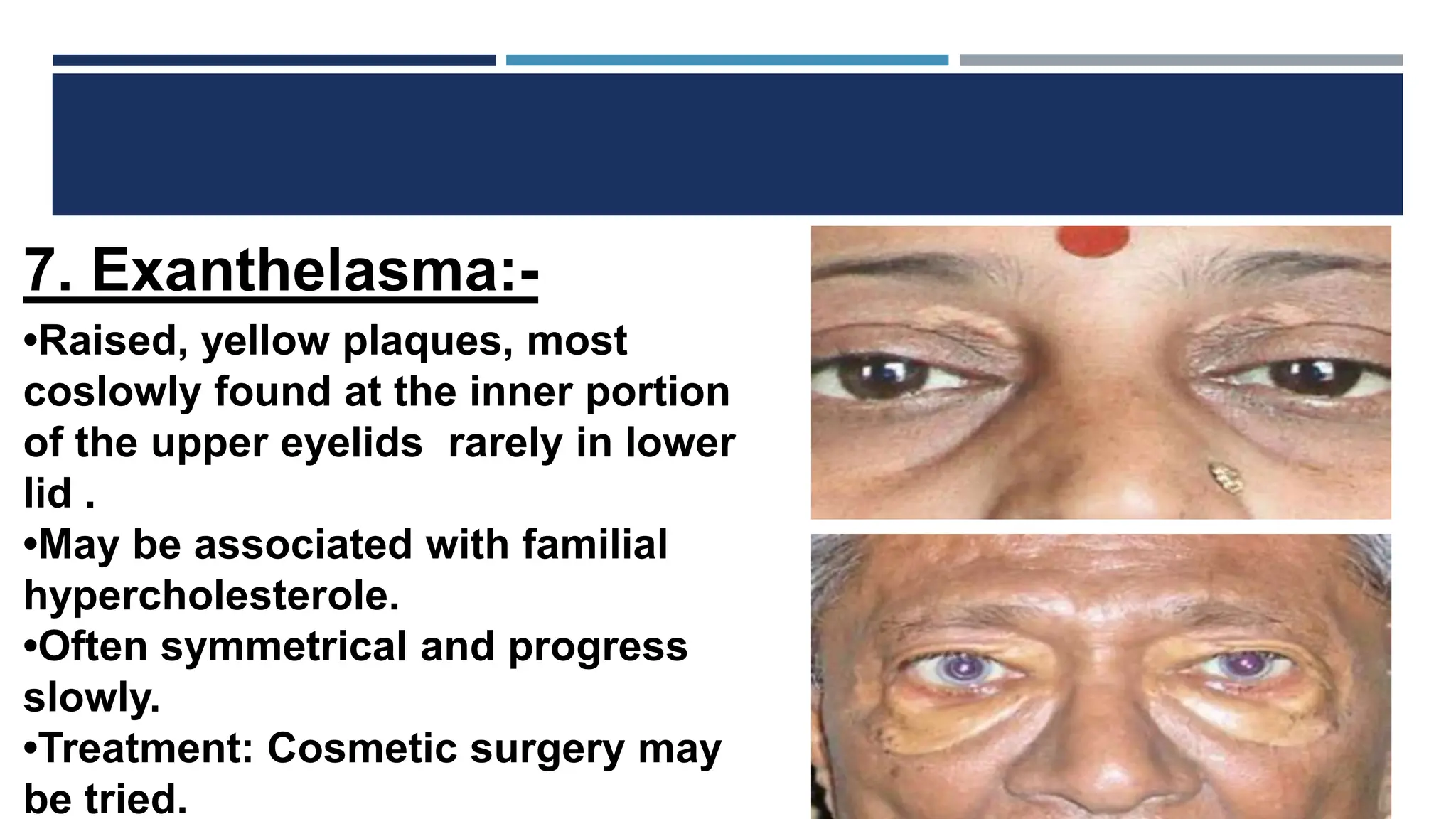 Diseases of eyelids like Epicanthus, entropian, ectropian, Telecanthus ...