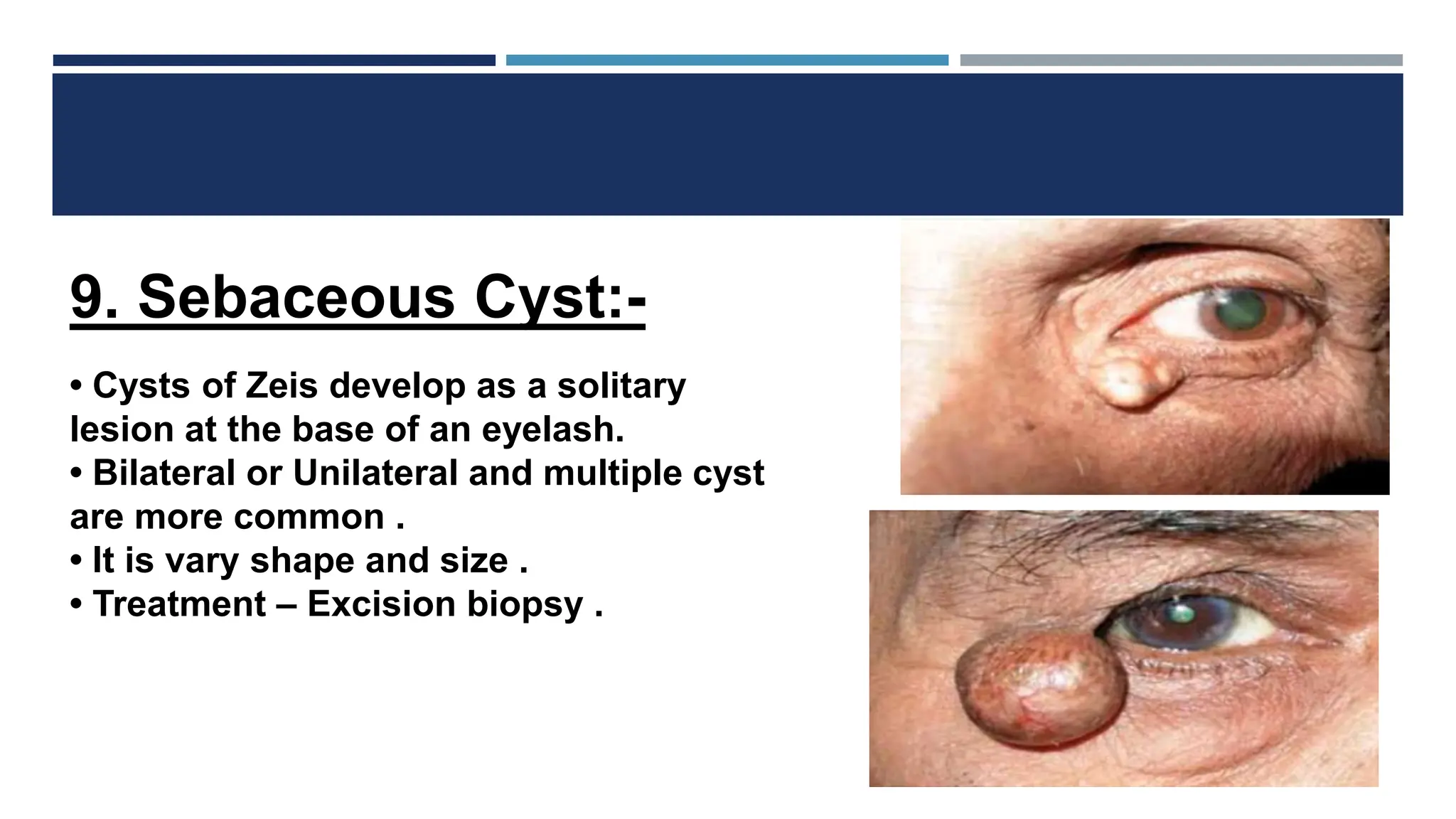 Diseases of eyelids like Epicanthus, entropian, ectropian, Telecanthus ...