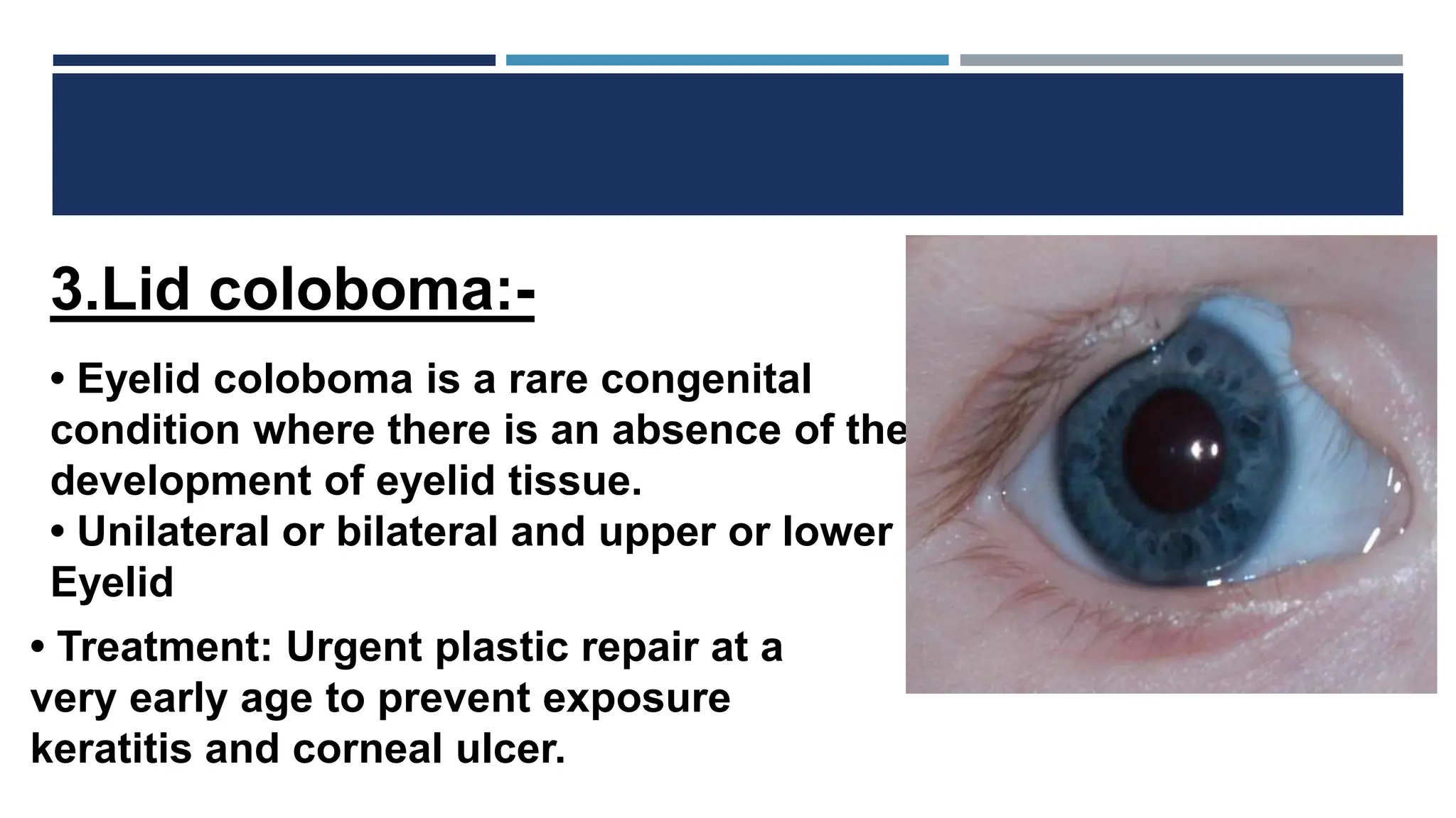 Diseases of eyelids like Epicanthus, entropian, ectropian, Telecanthus ...