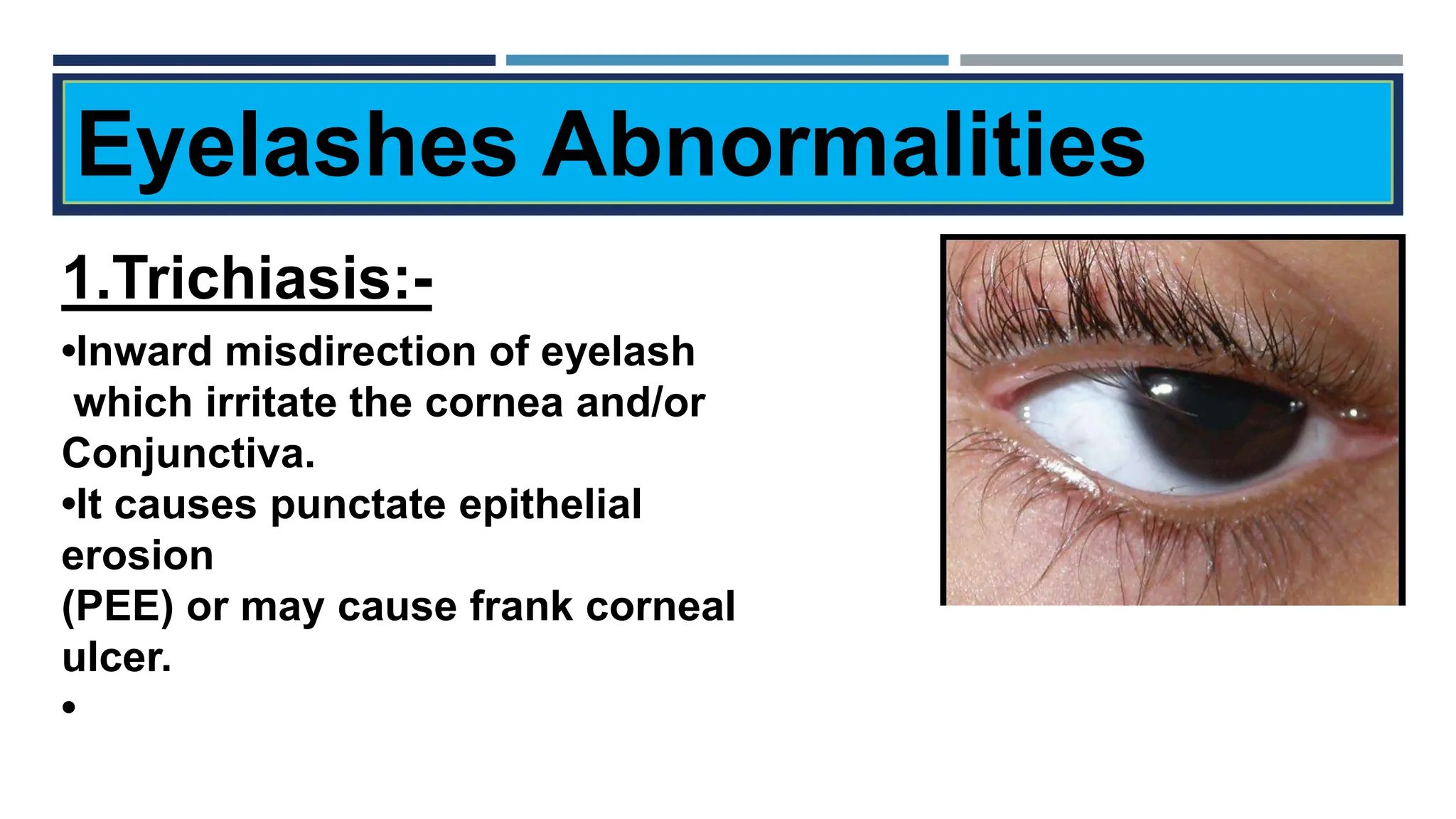 Diseases of eyelids like Epicanthus, entropian, ectropian, Telecanthus ...