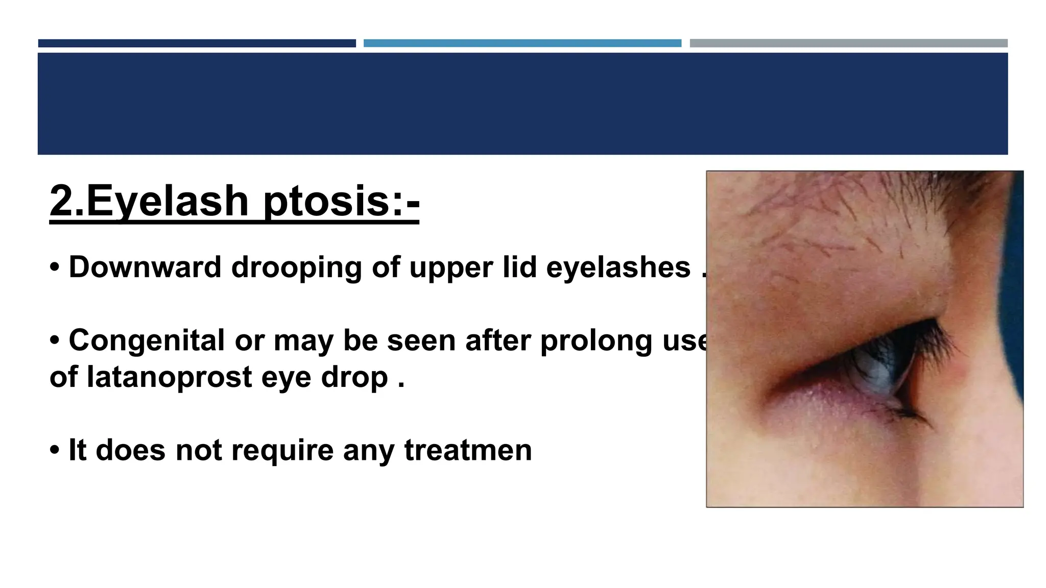 Diseases of eyelids like Epicanthus, entropian, ectropian, Telecanthus ...