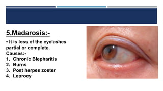 Diseases of eyelids like Epicanthus, entropian, ectropian, Telecanthus ...