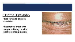Diseases of eyelids like Epicanthus, entropian, ectropian, Telecanthus ...