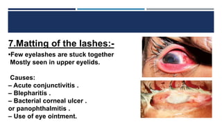 Diseases of eyelids like Epicanthus, entropian, ectropian, Telecanthus ...