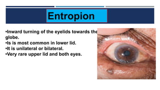 Diseases of eyelids like Epicanthus, entropian, ectropian, Telecanthus ...
