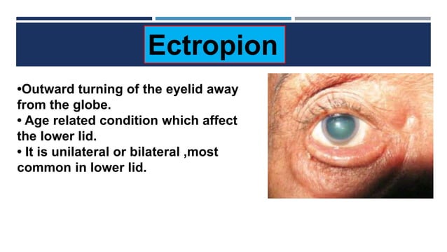 Diseases of eyelids like Epicanthus, entropian, ectropian, Telecanthus ...