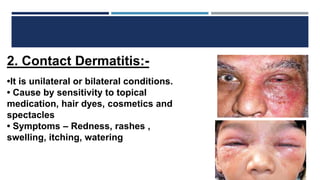 Diseases of eyelids like Epicanthus, entropian, ectropian, Telecanthus ...