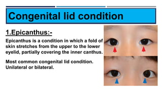 Diseases of eyelids like Epicanthus, entropian, ectropian, Telecanthus ...