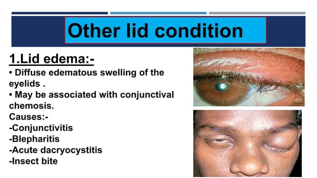 Diseases of eyelids like Epicanthus, entropian, ectropian, Telecanthus ...