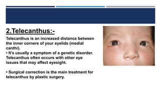 Diseases of eyelids like Epicanthus, entropian, ectropian, Telecanthus ...