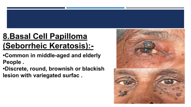 Diseases of eyelids like Epicanthus, entropian, ectropian, Telecanthus ...