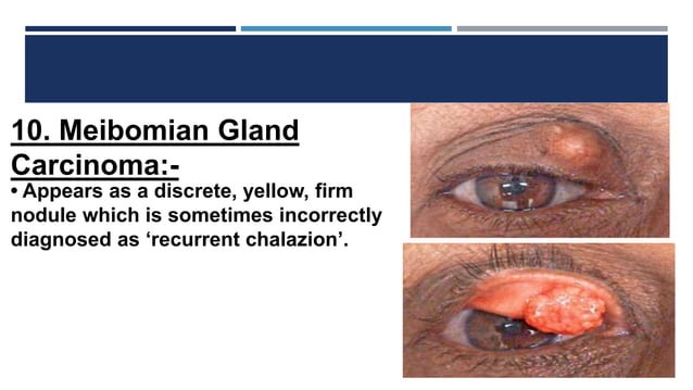 Diseases of eyelids like Epicanthus, entropian, ectropian, Telecanthus ...