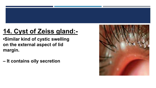 Diseases of eyelids like Epicanthus, entropian, ectropian, Telecanthus ...