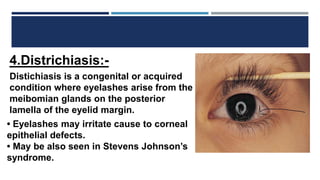 Diseases of eyelids like Epicanthus, entropian, ectropian, Telecanthus ...