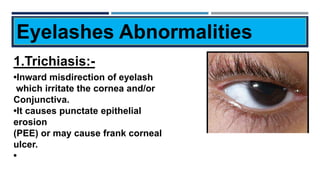 Diseases of eyelids like Epicanthus, entropian, ectropian, Telecanthus ...