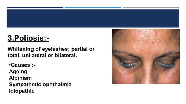 Diseases of eyelids like Epicanthus, entropian, ectropian, Telecanthus ...
