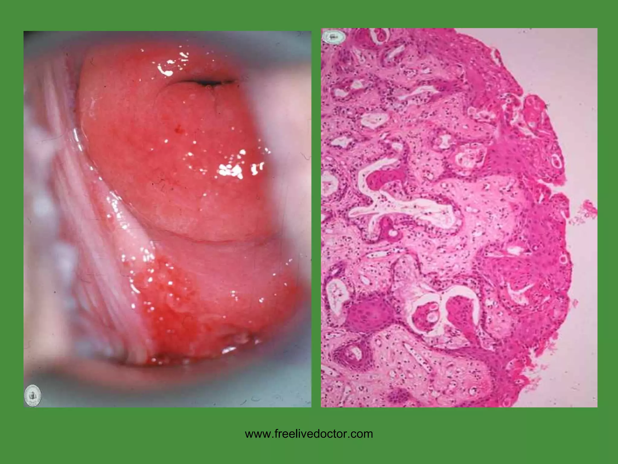 Diseases of female genital system | PPT