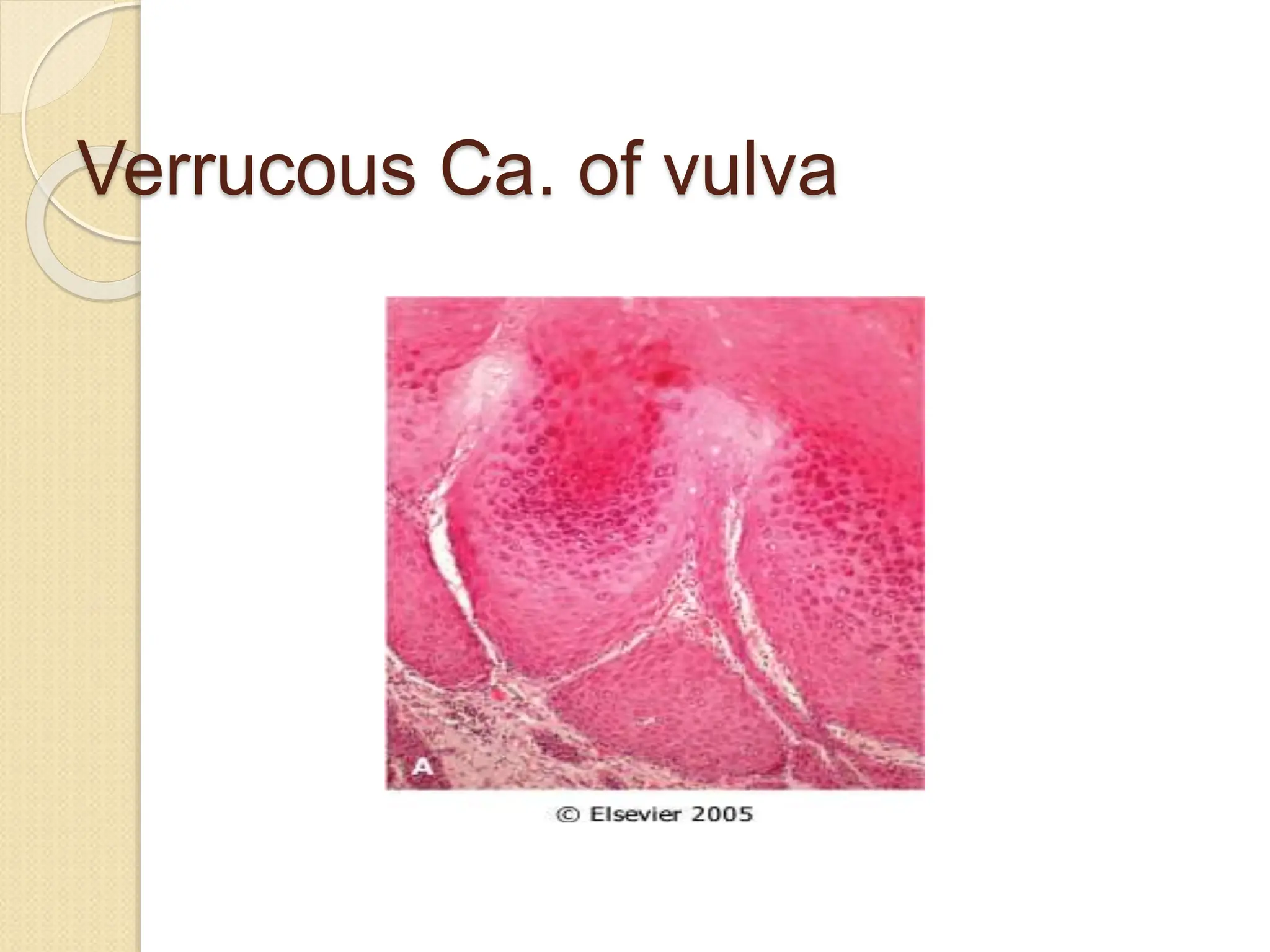 Diseases AND PATHOLOGY of Female Genital Tract1.ppt