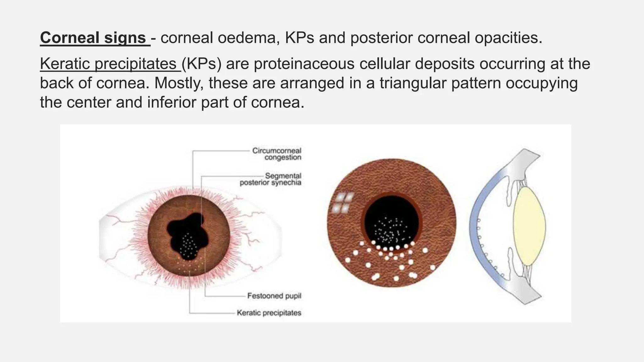 DISEASES OF IRIS.pptx