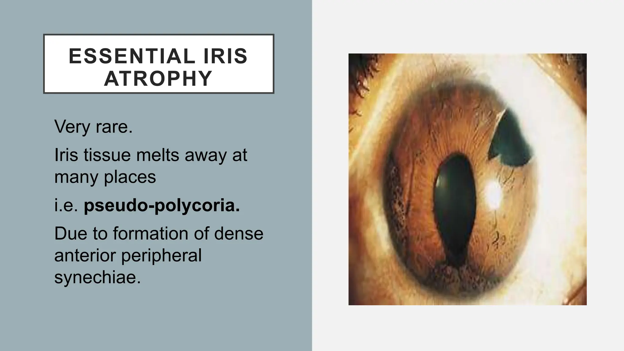 DISEASES OF IRIS.pptx