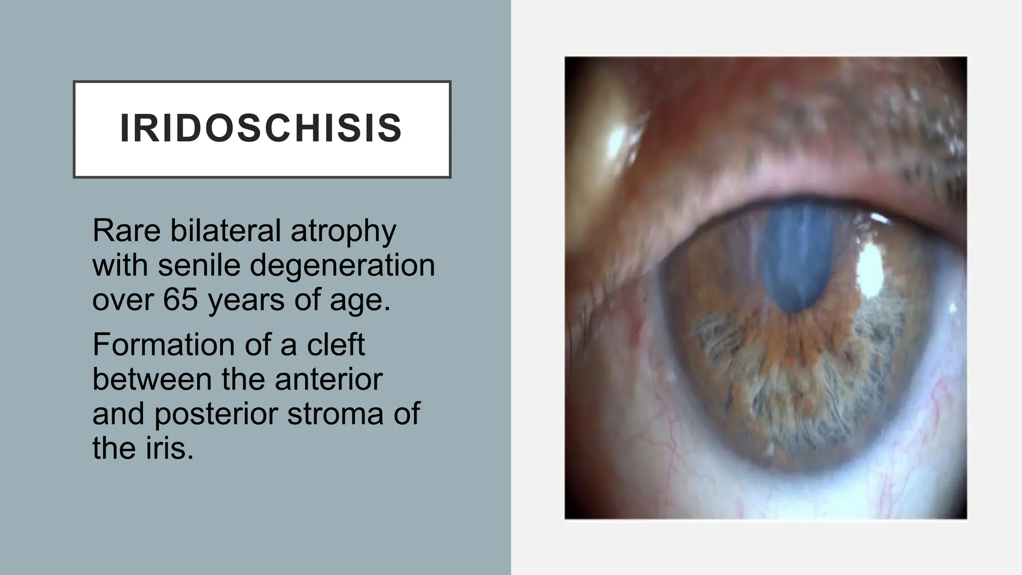 DISEASES OF IRIS.pptx