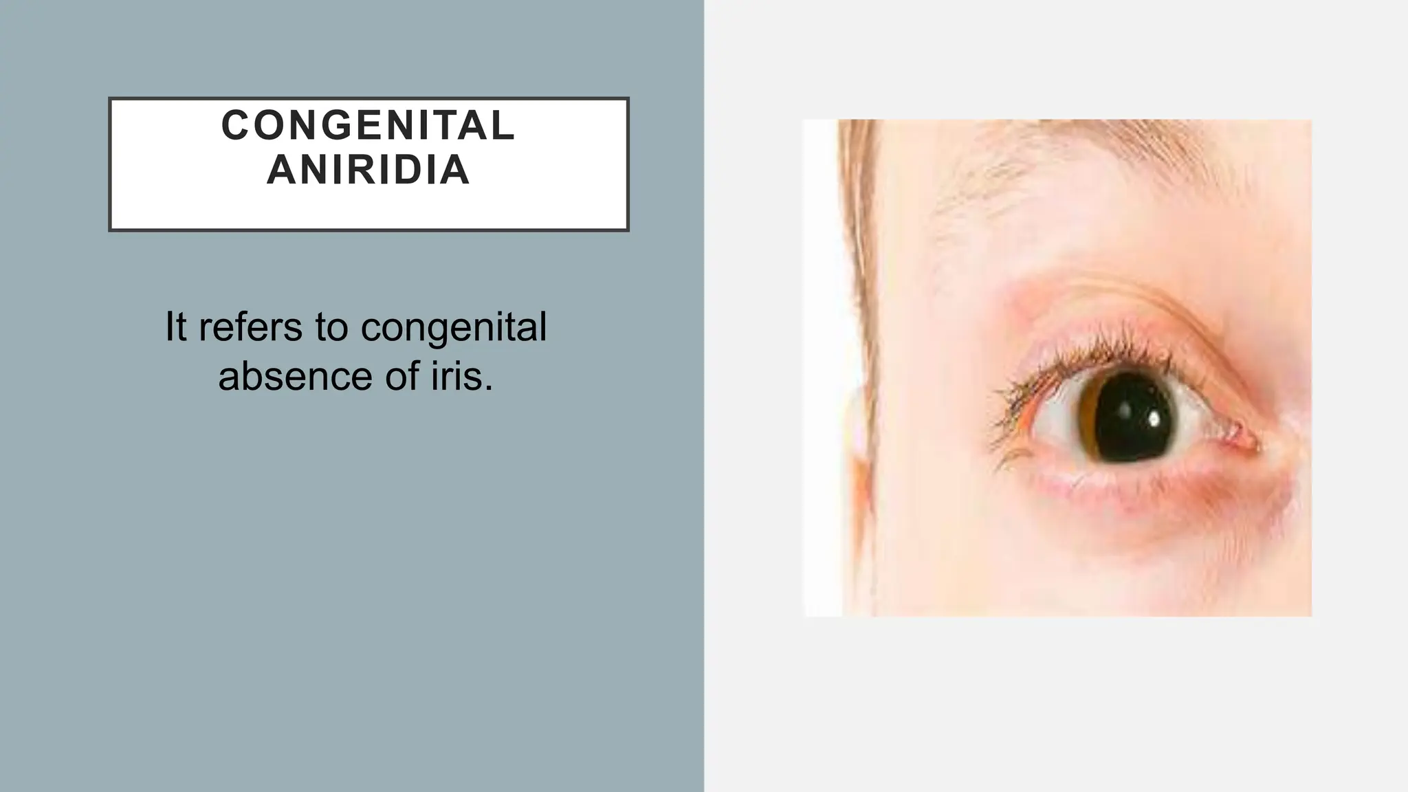 DISEASES OF IRIS.pptx