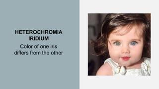 DISEASES OF IRIS.pptx