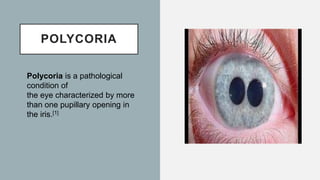 DISEASES OF IRIS.pptx