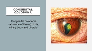 DISEASES OF IRIS.pptx