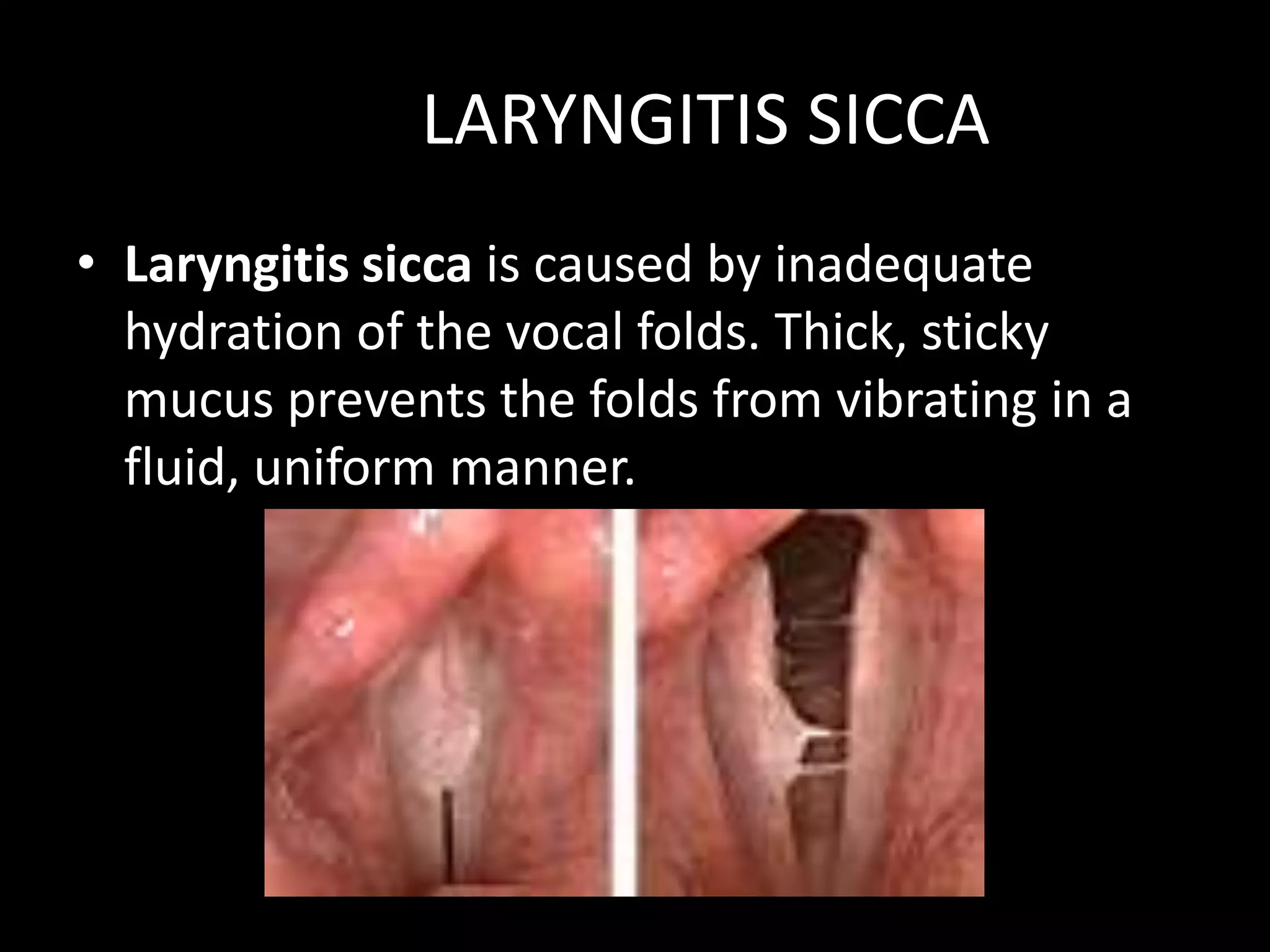 Diseases of larynx | PPTX