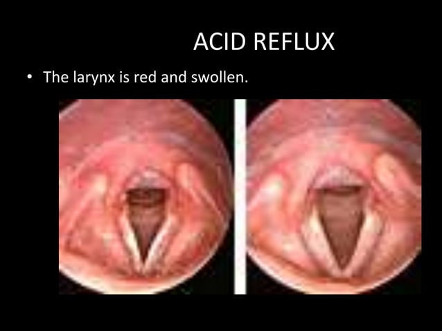 Diseases of larynx | PPTX | Ear, Nose and Throat Conditions | Diseases ...