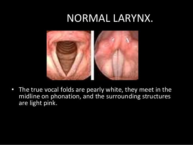 Diseases of larynx