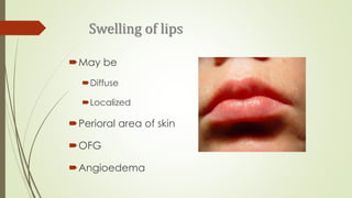 Diseases of lips & tongue | PPTX