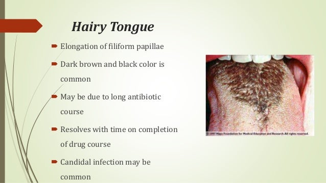 Brown Tongue Coating