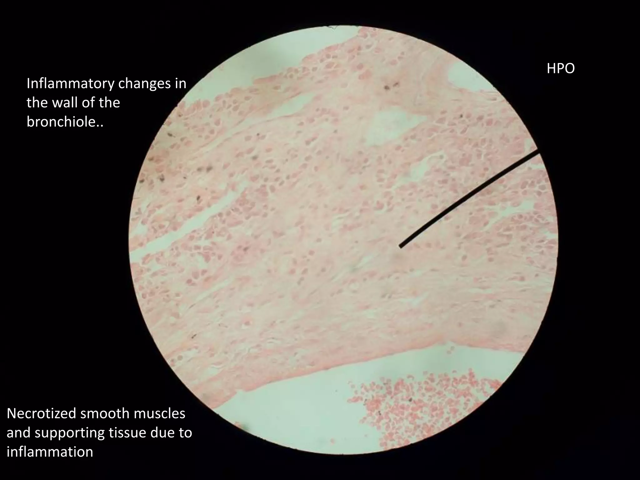 Diseases of lungs | PPTX