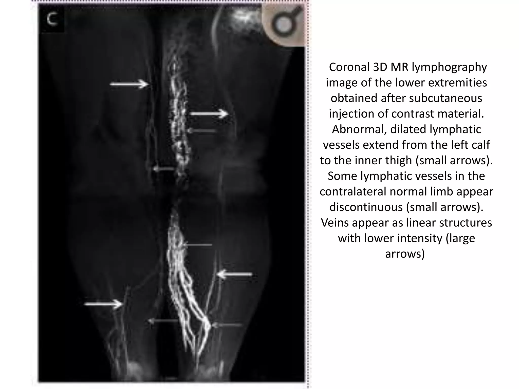 Diseases of lymphatic system | PPTX