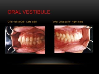 Vestibule Mouth