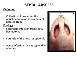 Diseases of nasal septum | PPT
