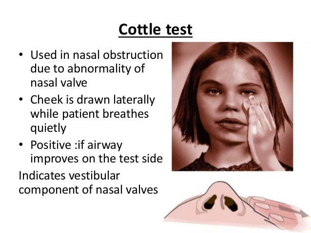 Diseases of nasal septum