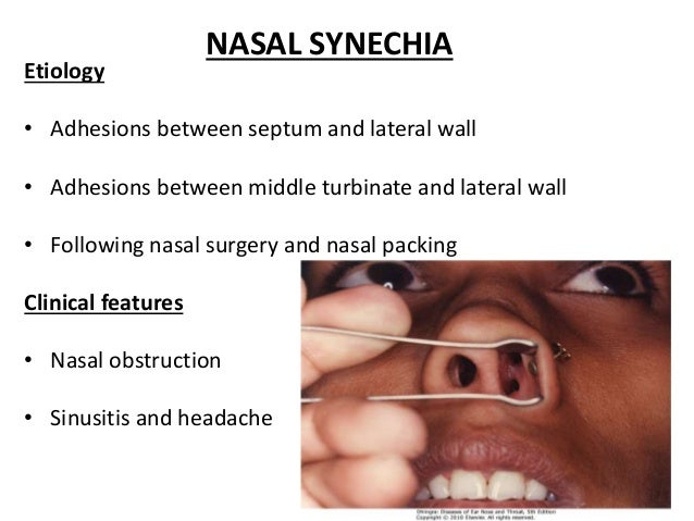 Diseases of nasal septum
