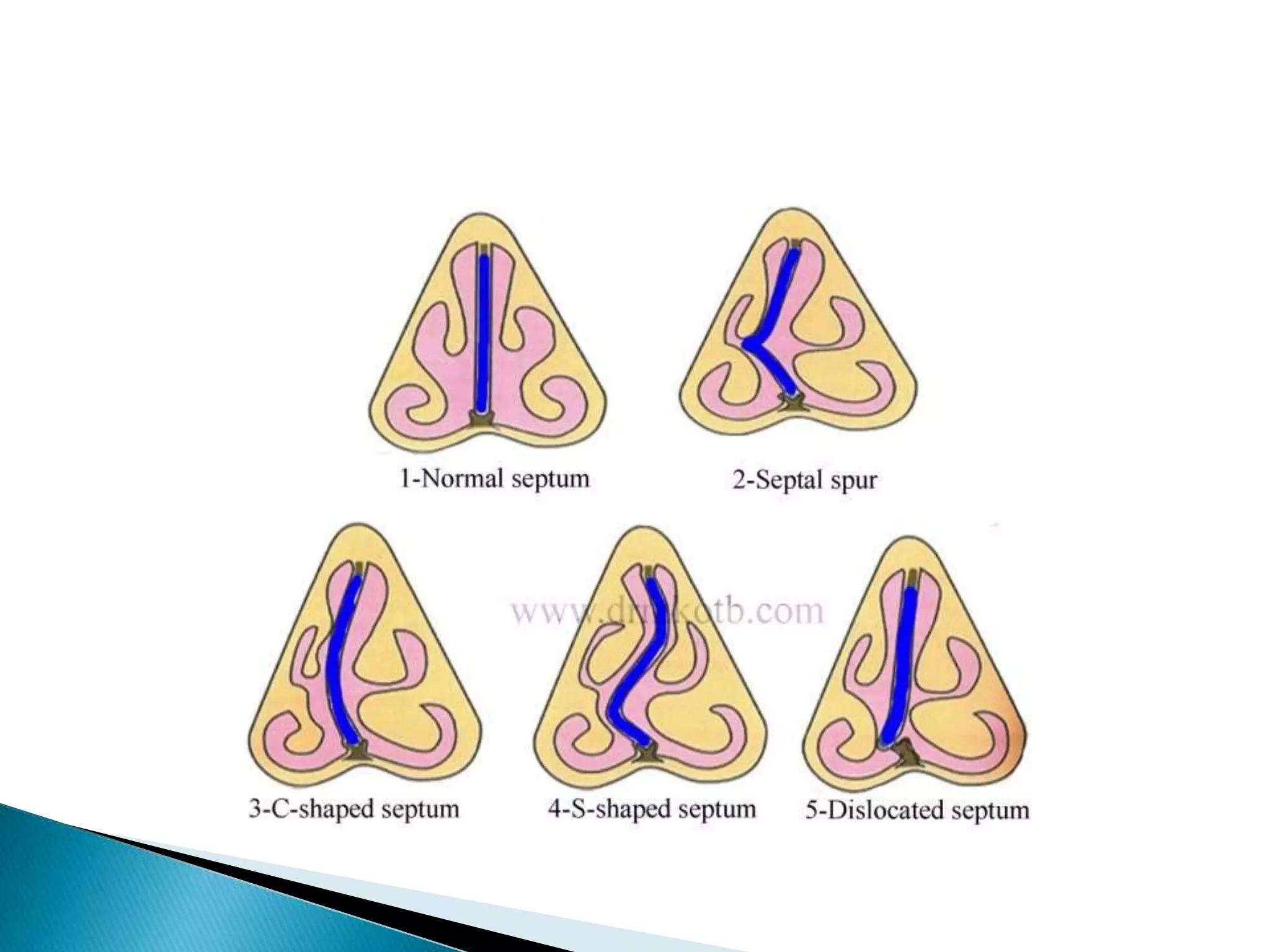 Diseases of nasal septum | PPTX