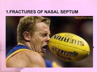 Diseases of nasal septum | PPTX
