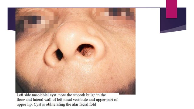 Diseases of nasal vestibule | PPTX | Ear, Nose and Throat Conditions ...